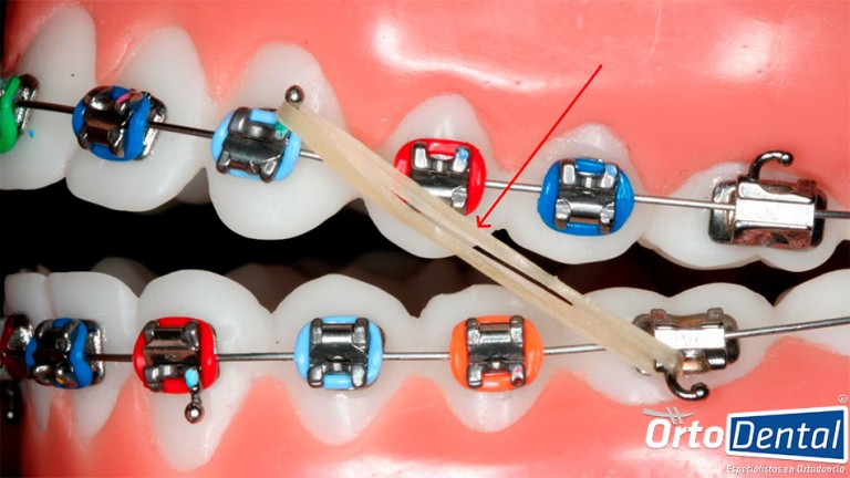 elasticos-intermaxilares-ortodoncia-mexico-df | OrtoDental ...