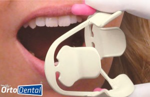 colocacion-del-retractor-ortodental-mexico | OrtoDental | Ortodoncista ...
