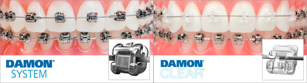 Brackets Damon y Damon Clear | OrtoDental | Ortodoncista en Mexico CDMX ...