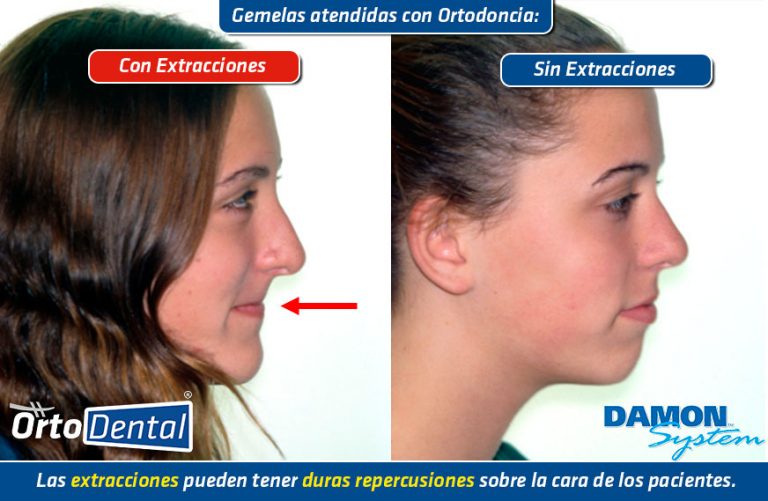 comparativa-gemelas-extracciones-vs-no-extracciones-damon-system ...