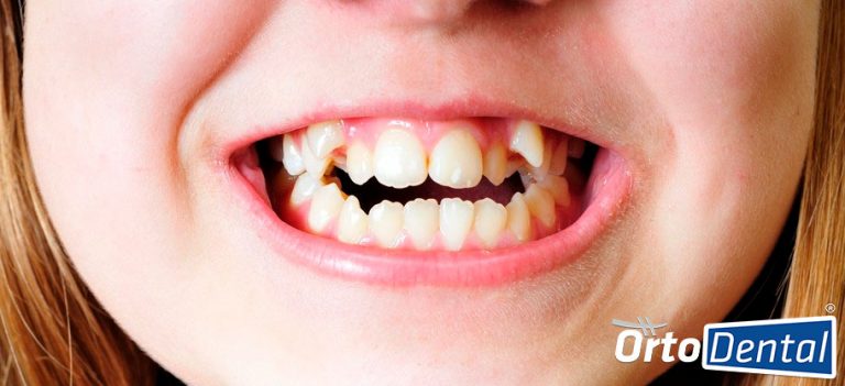 ¿Qué es el Apiñamiento o Amontonamiento de los Dientes? | OrtoDental ...