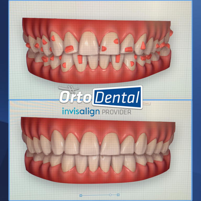 ClinCheck de Invisalign, un software inteligente | OrtoDental ...