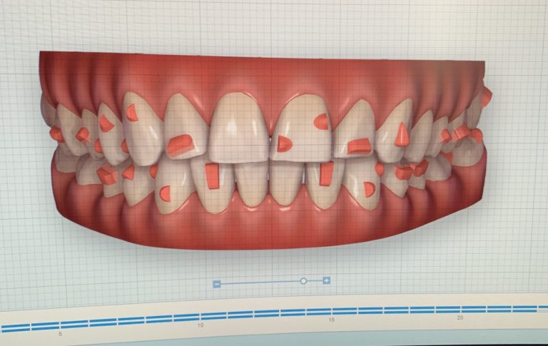 ClinCheck de Invisalign, un software inteligente | OrtoDental ...