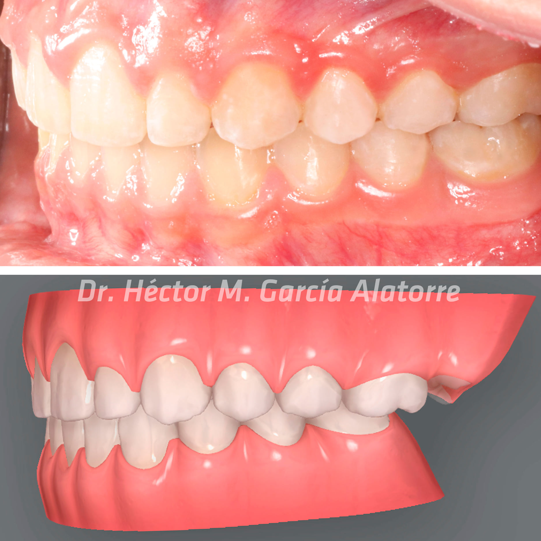 Caso 4 Avance Mandibular - Después | OrtoDental | Ortodoncista en ...