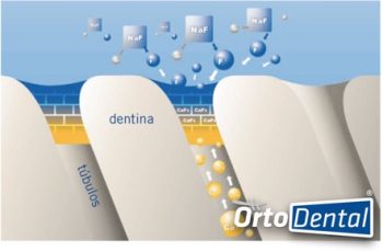 Voco Profluorid Varnish, Una Solución a Tus Dientes Sensibles ...