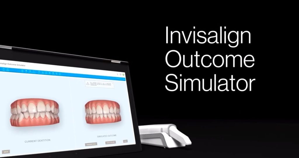 Nuevo Escáner Intraoral iTero 5D, Transforma tu Experiencia de ...