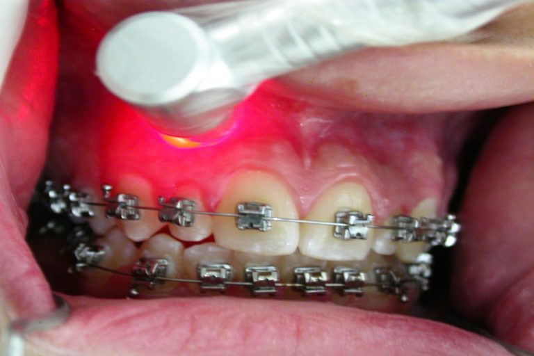 La Terapia Láser de Baja Intensidad (LLLT) en Ortodoncia | OrtoDental ...
