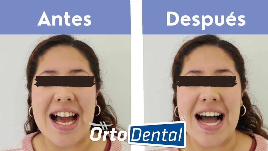 Invisalign In-Face Visualization: Visualiza tu Nueva Sonrisa Antes de ...