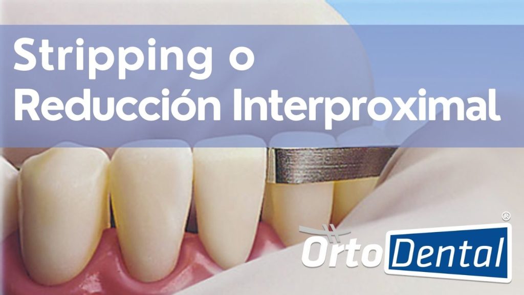 ¿Que es el Stripping o Reduccion Interproximal en Ortodoncia y para que ...