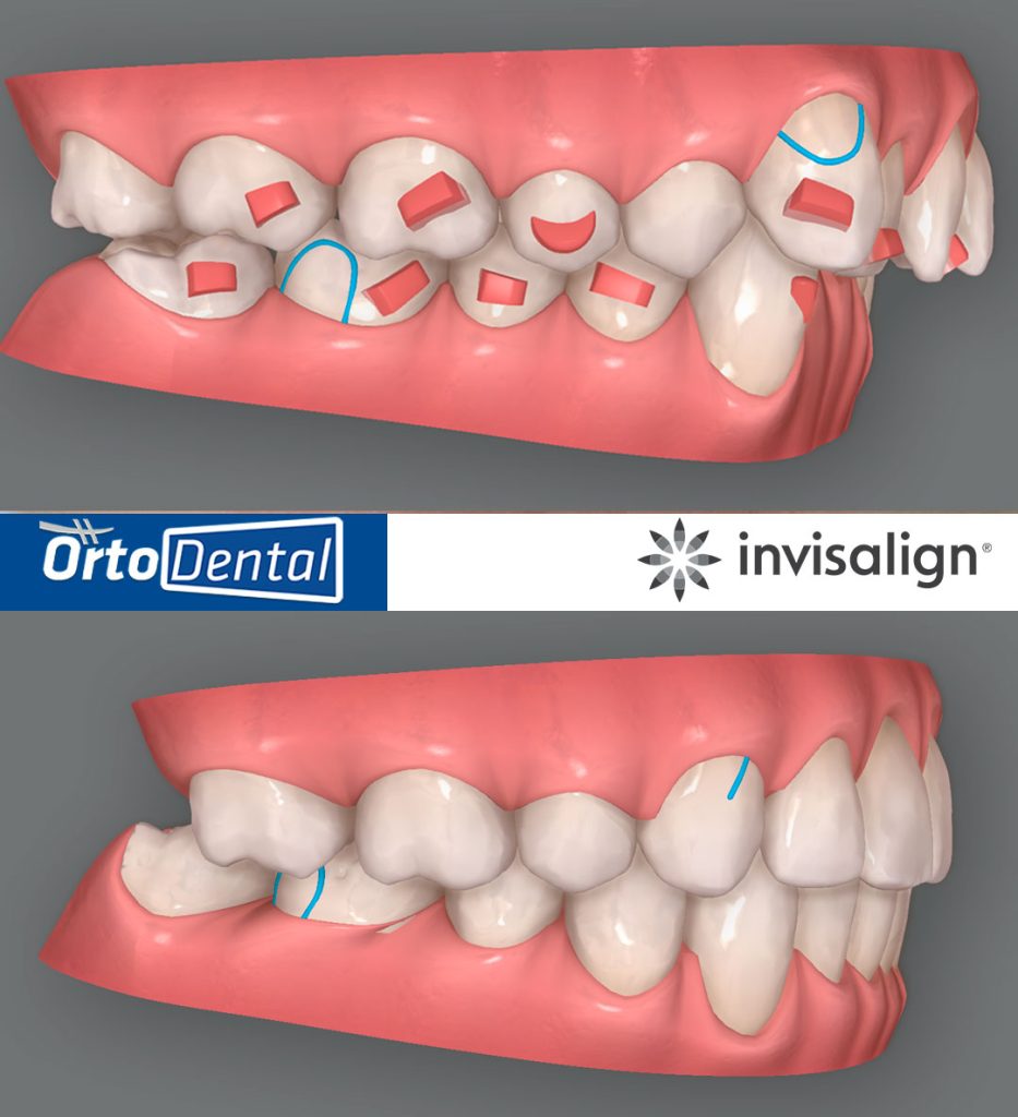 ¿Qué es la Clase II con Mordida Profunda y Apiñamiento Severo en ...