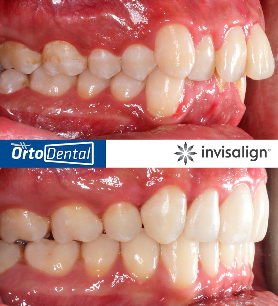¿Qué es la Clase II con Mordida Profunda y Apiñamiento Severo en Ortodoncia? | OrtoDental ...