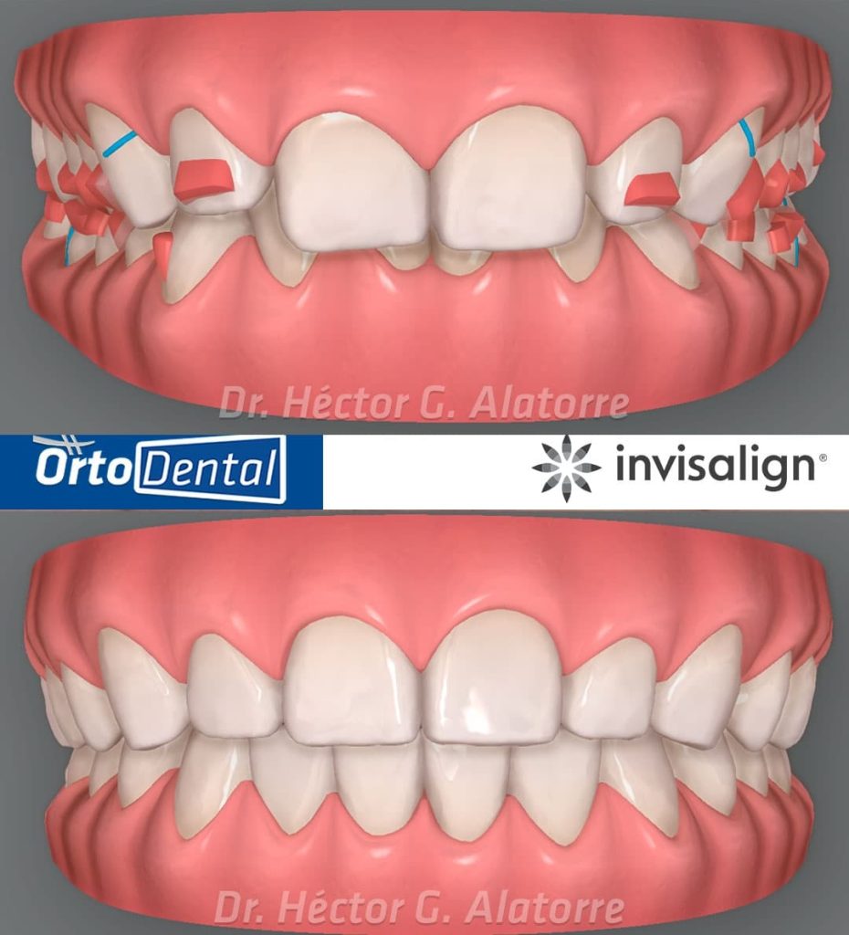 Te explicamos un Caso de Clase II Mordida Profunda | OrtoDental ...